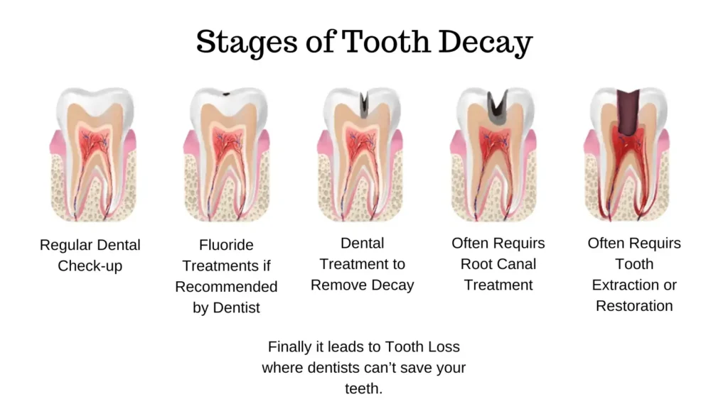 tooth decay at 21